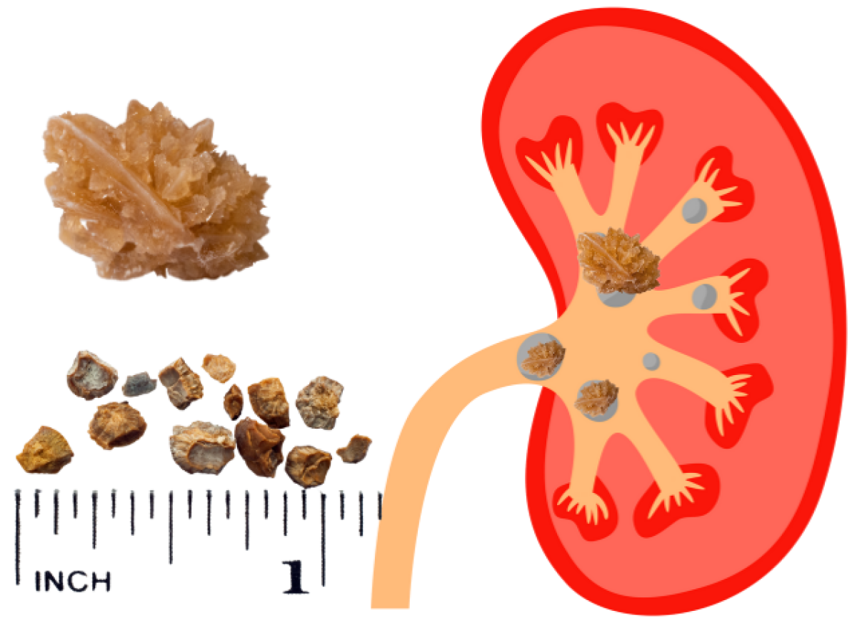 Red Orange Kidney Stone